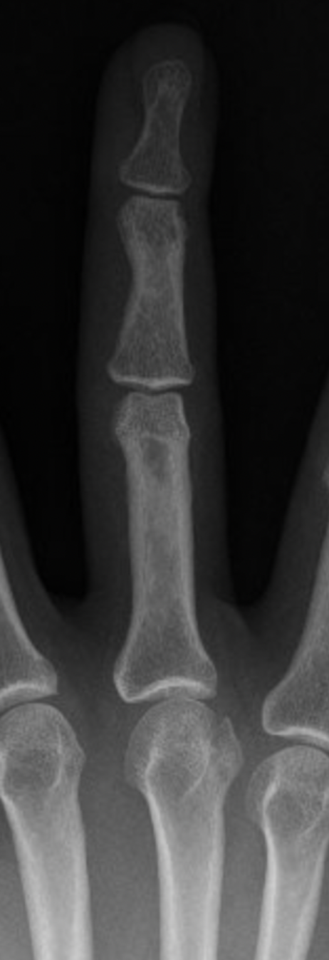 Dr. Sammy - Joint Denervation