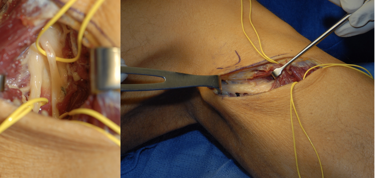 Dr. Sammy - Common Peroneal Nerve (CPN) Compression
